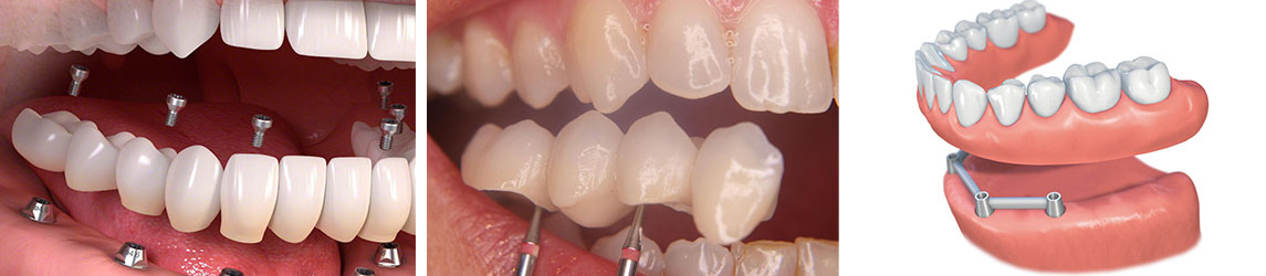 Dentalne usluge | Privatna ordinacija dentalne medicine Aleksandra ...